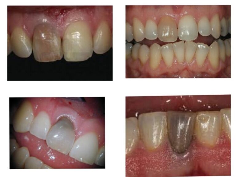 Tooth Pain – Trauma Chapter 4 ( Part A) – Dentistry and Dental Implants ...