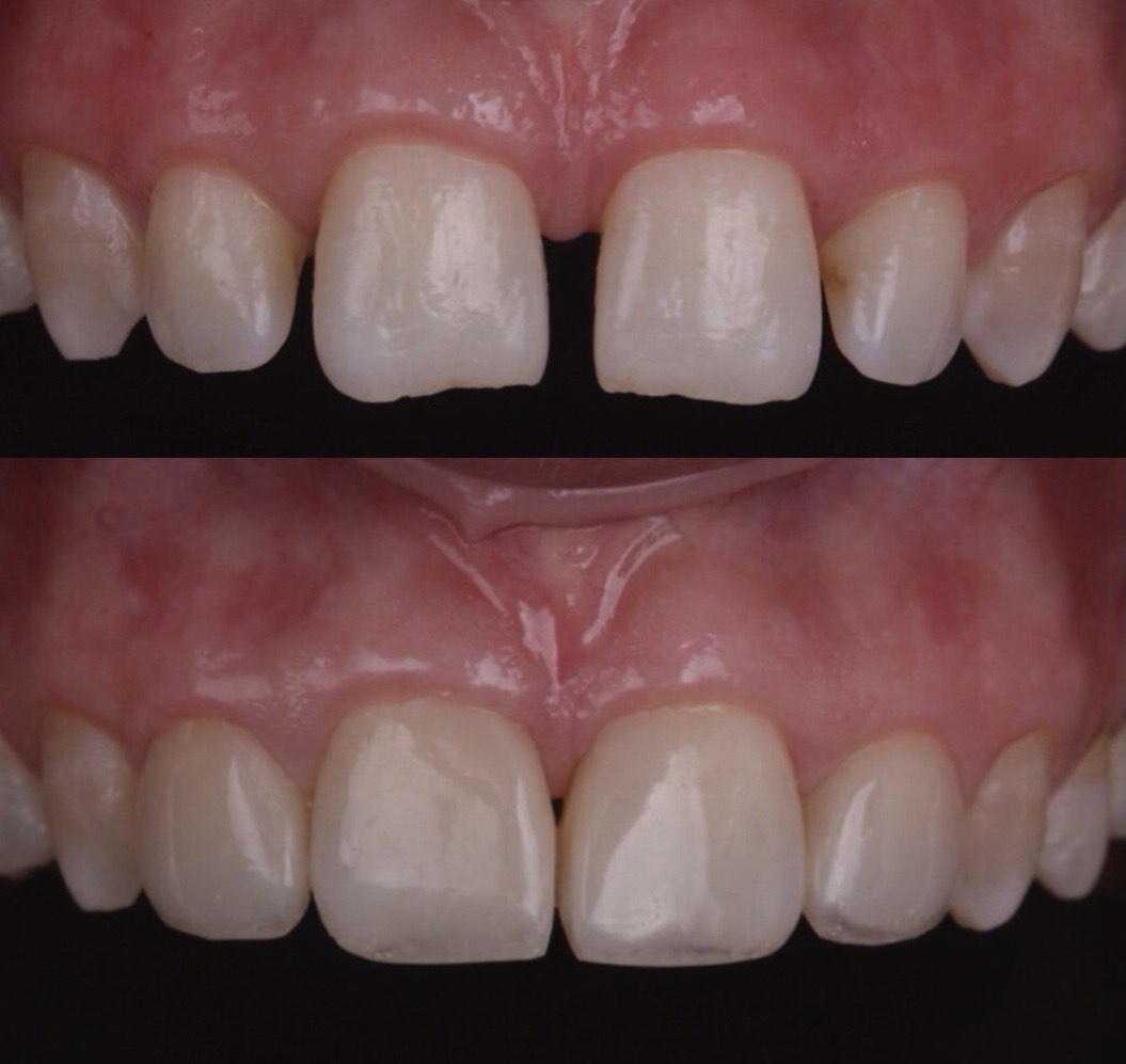 Chapter 12 – Gap in front teeth – Dentistry and Dental Implants Blog ...